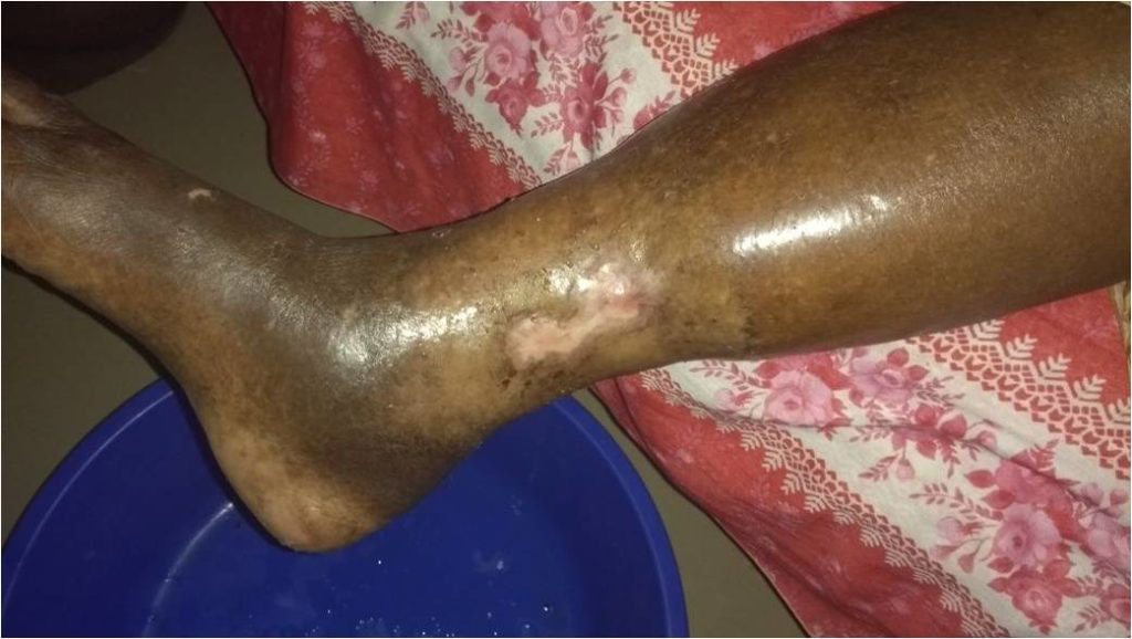 AgFix Silver Foam Dressings for Foot Ulcers - Case Studies