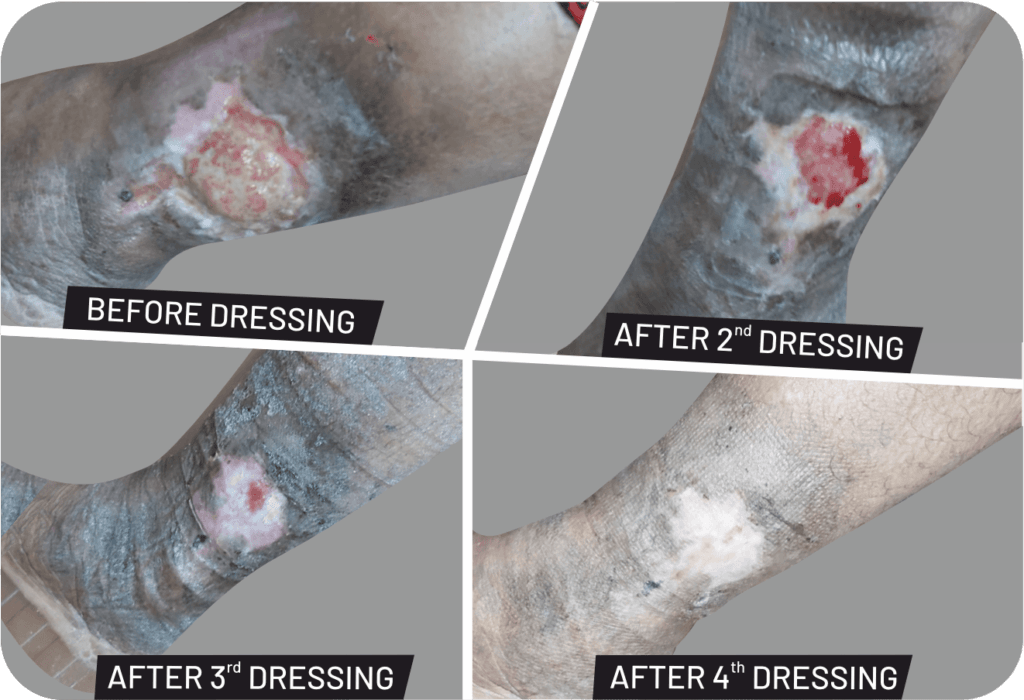 Foam Dressings with Silver - AgFix | Dynamic Techno Medicals