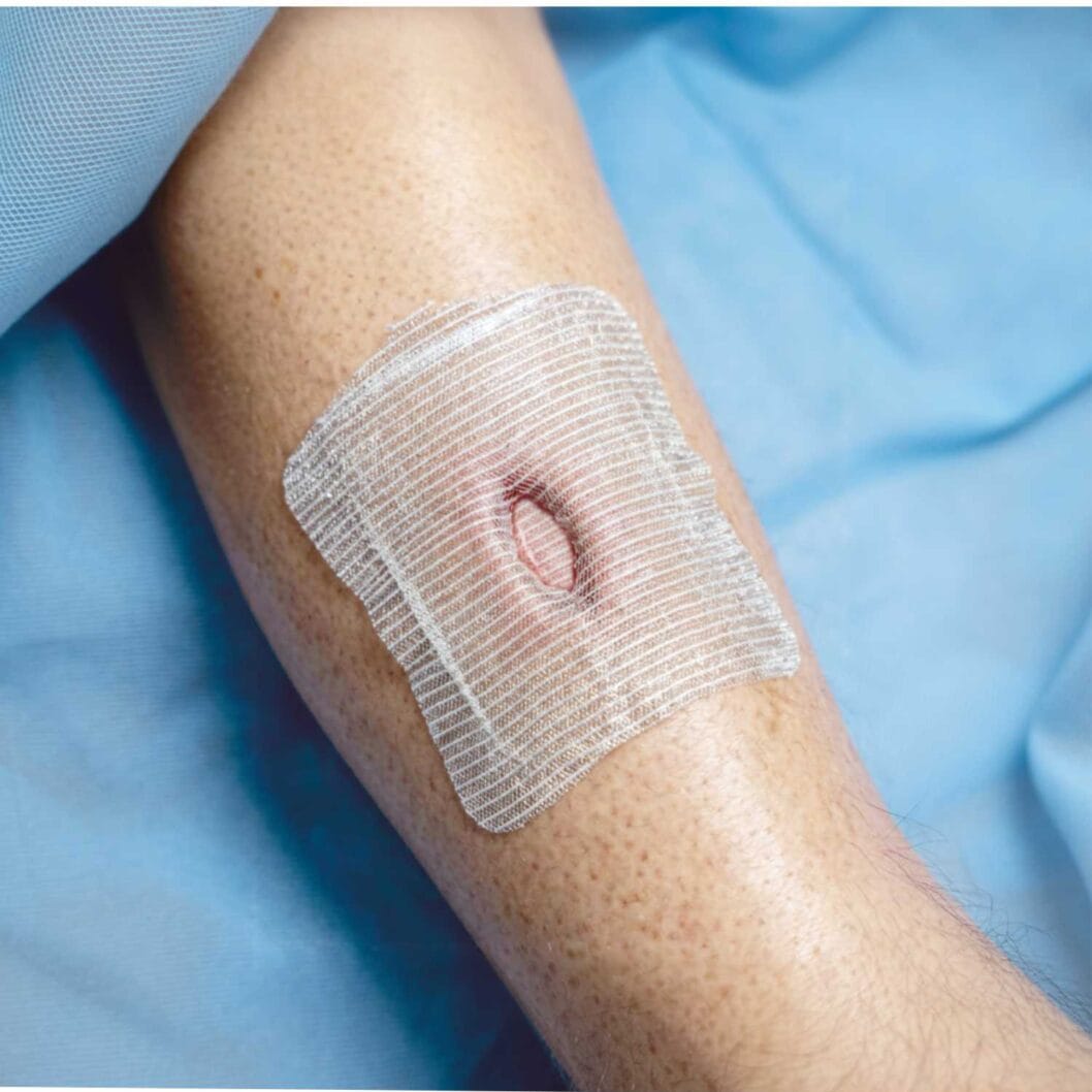 Sterizone ST Antimicrobial Silver Wound Dressing - Pack of 4 - Dynamic ...